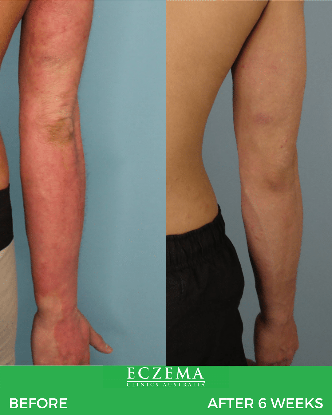 Gallery - Eczema Clinics Australia